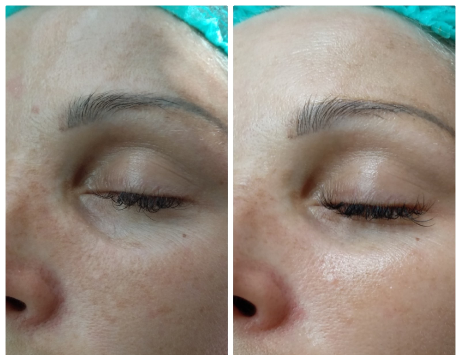 What is carboxy therapy? - Auko