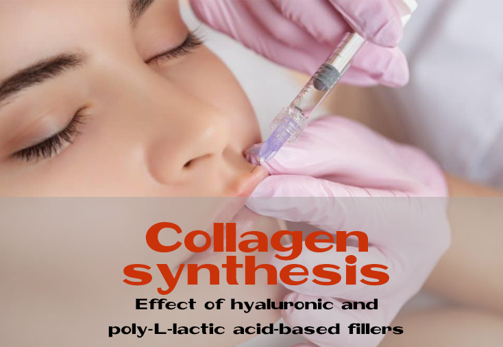 Effect of hyaluronic and poly-L-lactic acid-based fillers on Сollagen ...